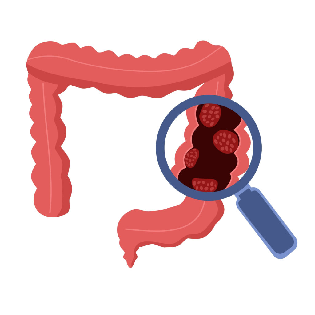 Veelvoorkomende aandoeningen darmen - Darmklachten.nl